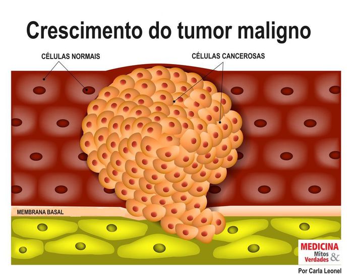 O que e o cancer... :: Cancerdoencadofuturo